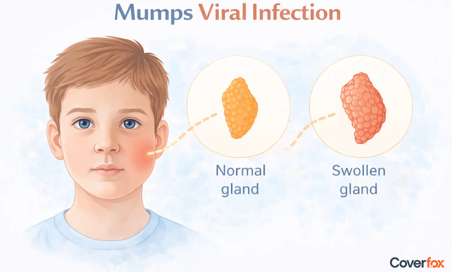 Mumps Infection: Symptoms, Causes, Risks & Vaccine Safety