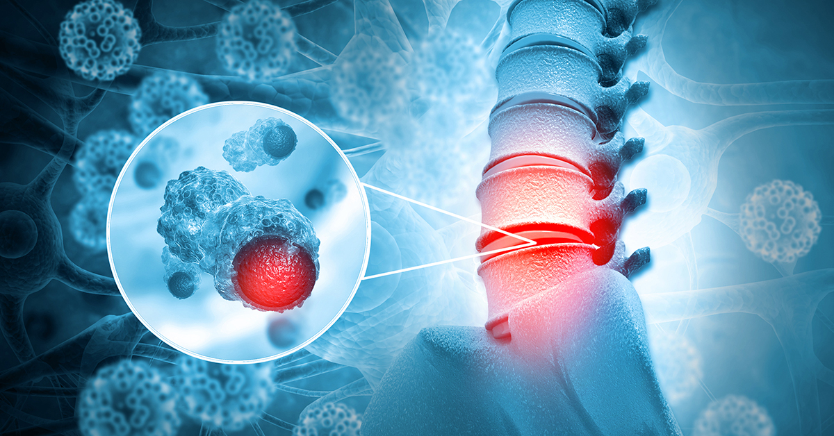 Bone Cancer Health Insurance | Diseases